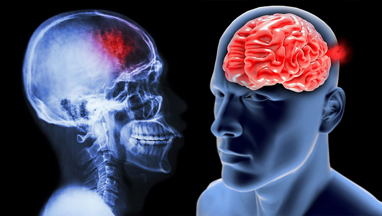 Por primera vez, logran regenerar tejido cerebral tras un ataque ...